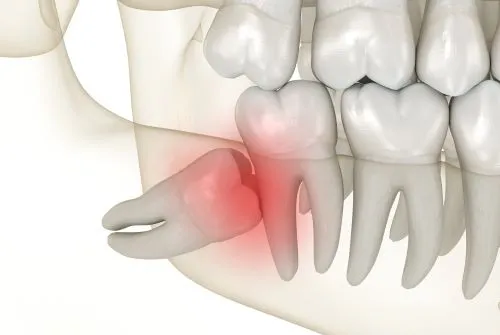 Understanding Wisdom Teeth Extraction: What to Expect Before, During ...